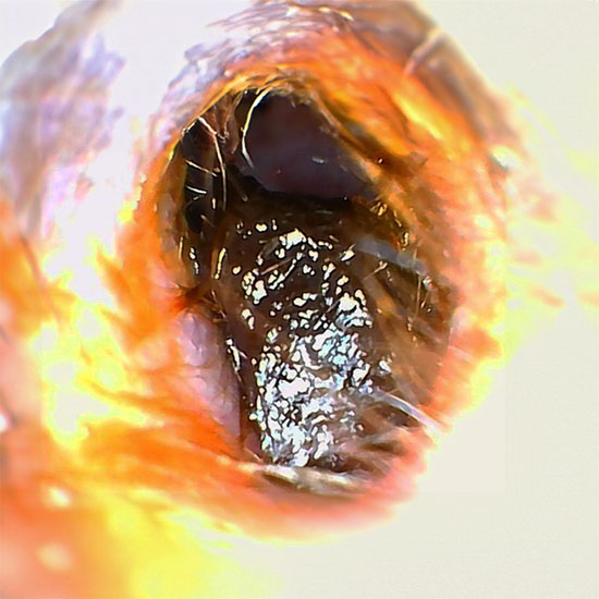 Micro-Suction Earwax Removal - Mobile Ear Wax Specialist